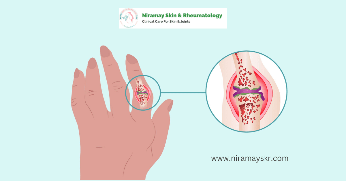 Rheumatoid Arthritis Treatment In Karnal Niramay Clinic